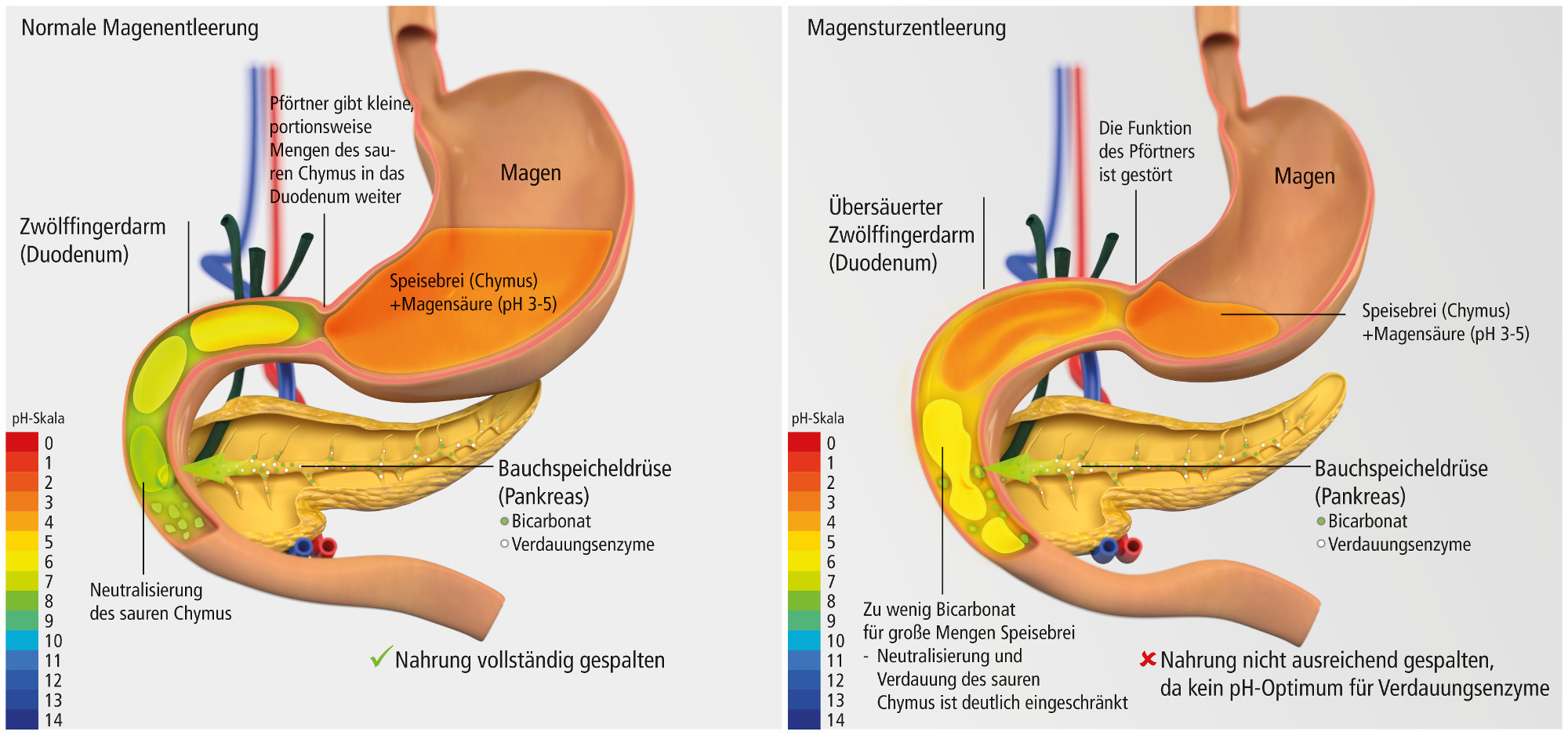Niedriger pH im Duodenum und unzureichende Chymus-Durchmischung ...