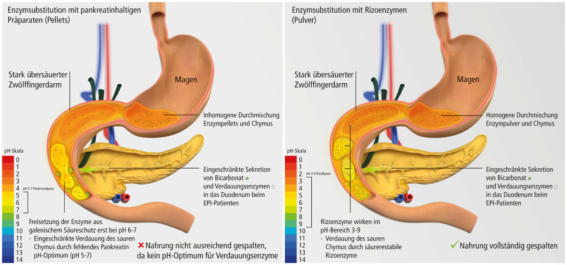 Niedriger pH im Duodenum und unzureichende Chymus-Durchmischung ...